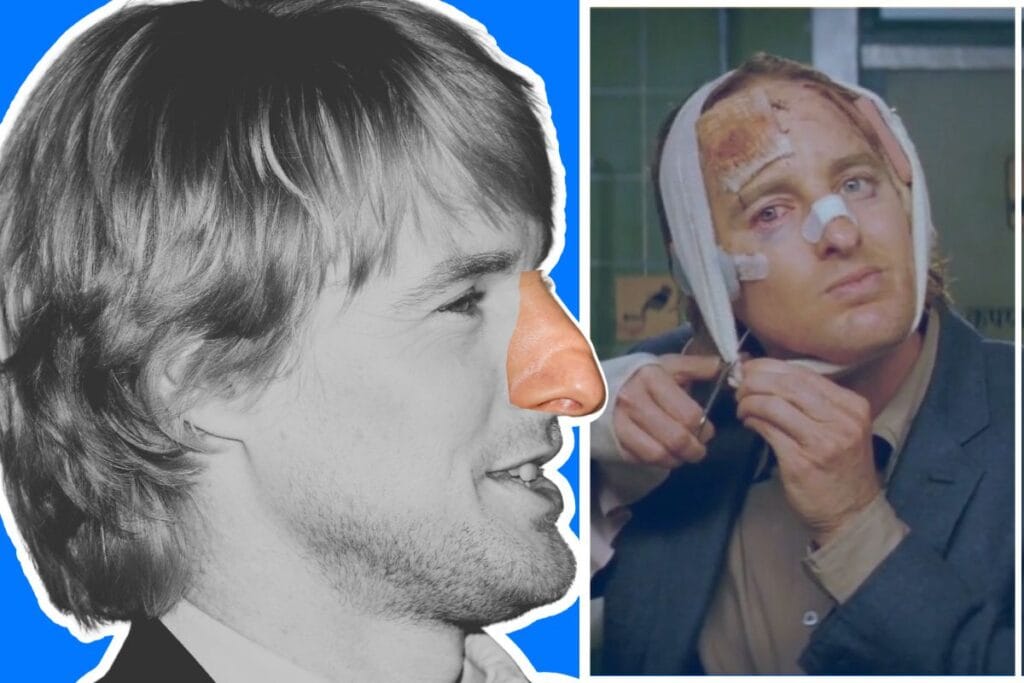 What Really Happened to Owen Wilson Nose